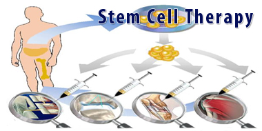 STEM CELL THERAPY