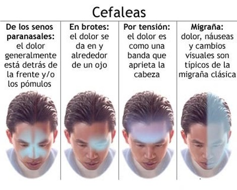 ¿Conoces las diferencias entre cefalea tensional y migrañas? ~ Fernanda ...