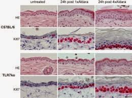 Medical Treatment Pictures-for Better Understanding: Lymphoma of Skin ...