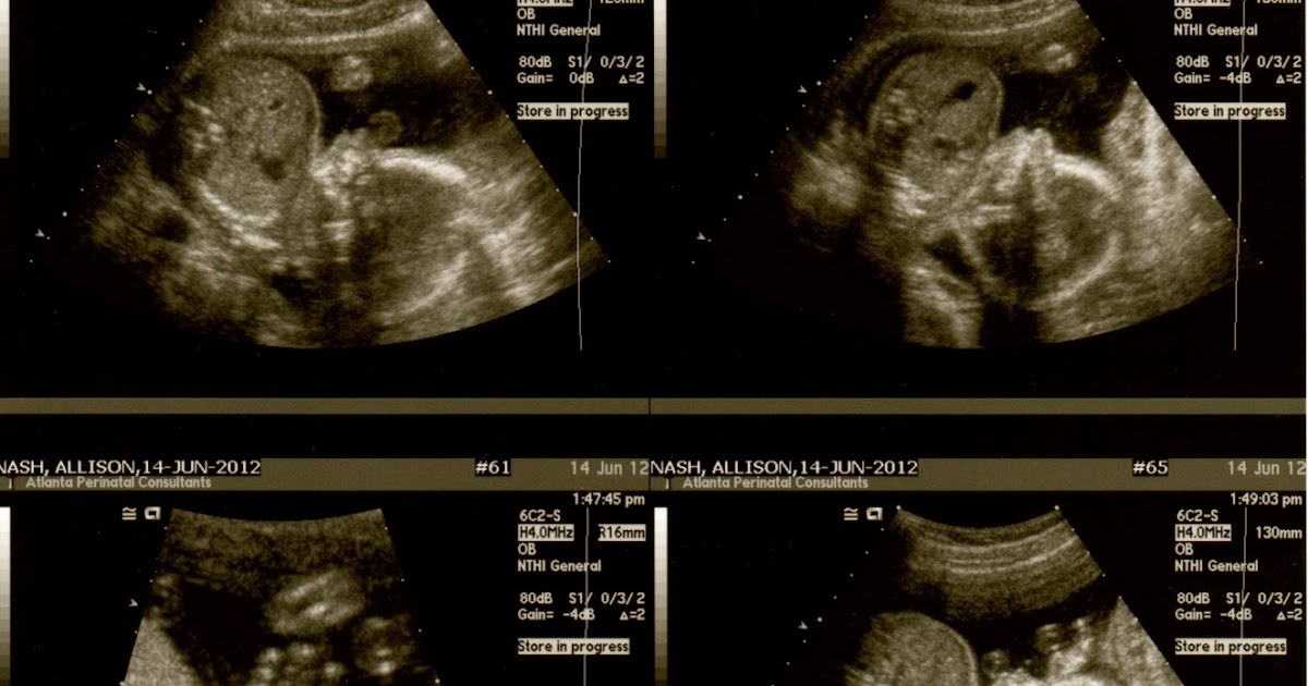 Sweet Baby Nash: 20 Week Anatomy Scan