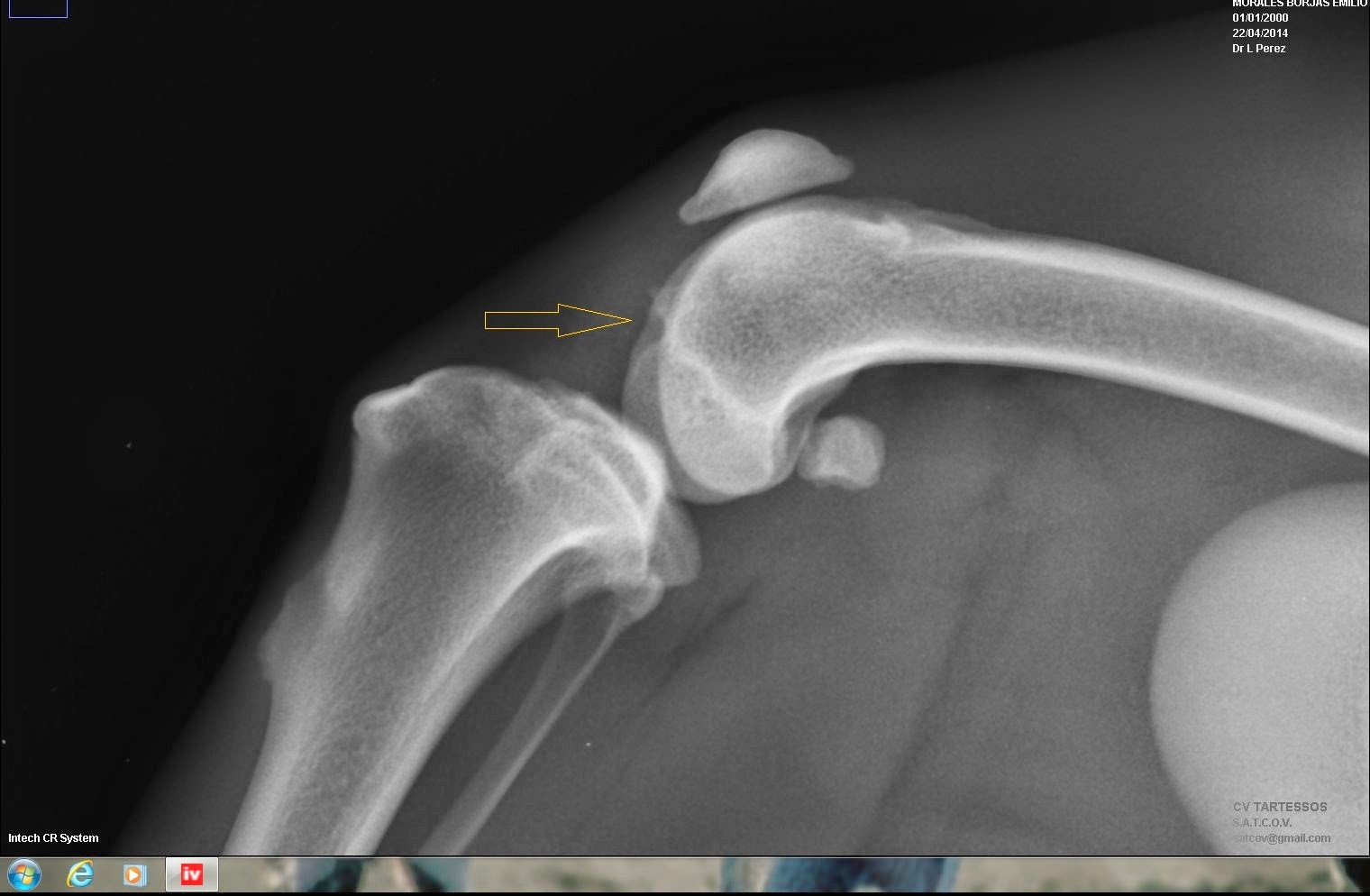 Traumatologia y Cirugia Ortopedica Veterinaria: LUXACION DE ROTULA CON ...