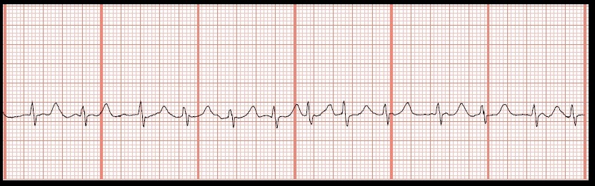 Practice EKG Rhythm Strips 124