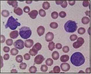 HEMATOLOGIA: LEUCEMIA MIELOIDE AGUDA M2 (CLASIFICACIÓN FAB)
