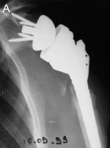 Shoulder Arthritis / Rotator Cuff Tears / Shoulder Pain : Grammont ...