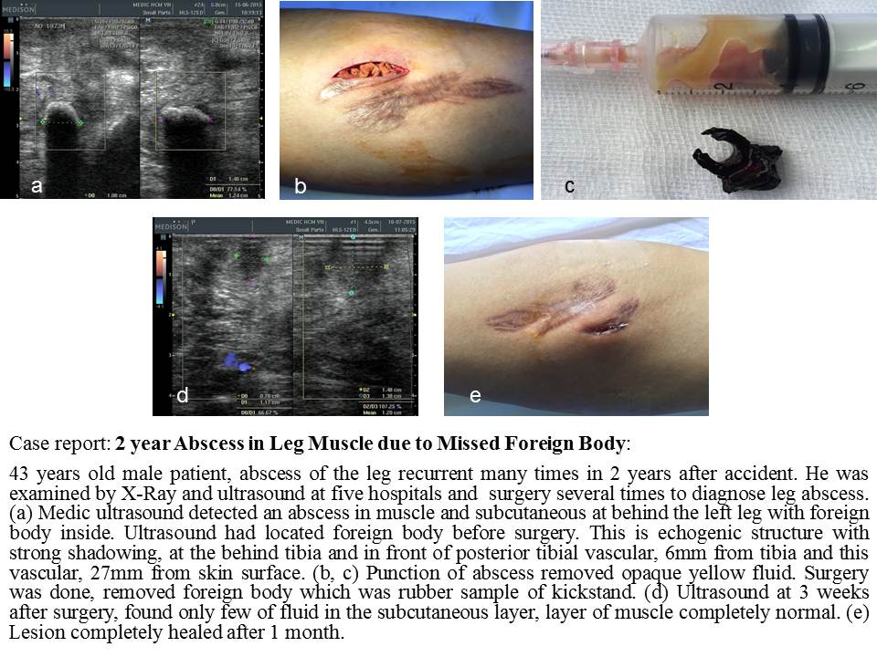 VIETNAMESE MEDIC ULTRASOUND: CASE 336:02 year Abscess in Leg Muscle due ...