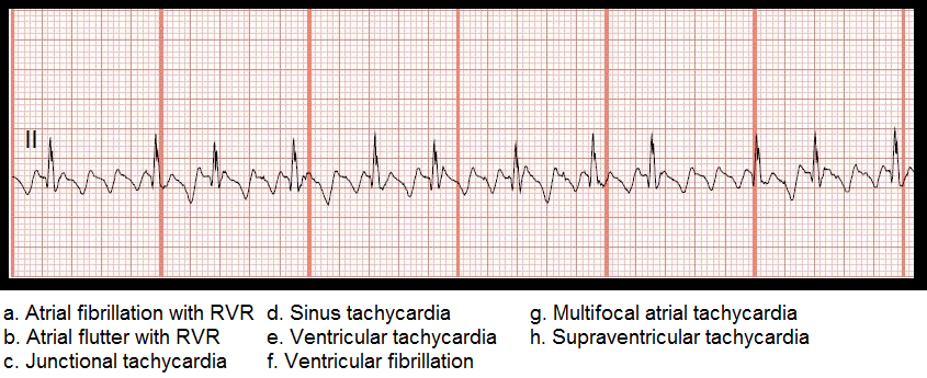 Fast Heart Rhythm Quiz 295
