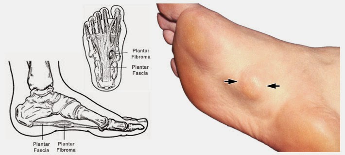 The Foot and Ankle Tribune: Masses on your foot