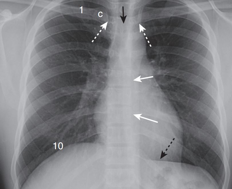 Reading chest radiograph - Penetration ~ Medicine Hack