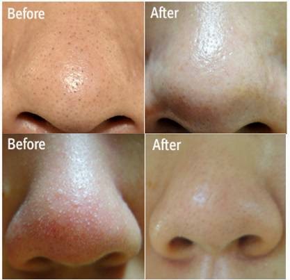 JITIBU TATIZO LA VIPELE KWENYE USO (CHUNUSI) KWA NJIA ZA ASILI ~ Mzizi ...