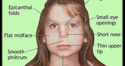 Adult with fetal alcohol syndrome face - yrabrands