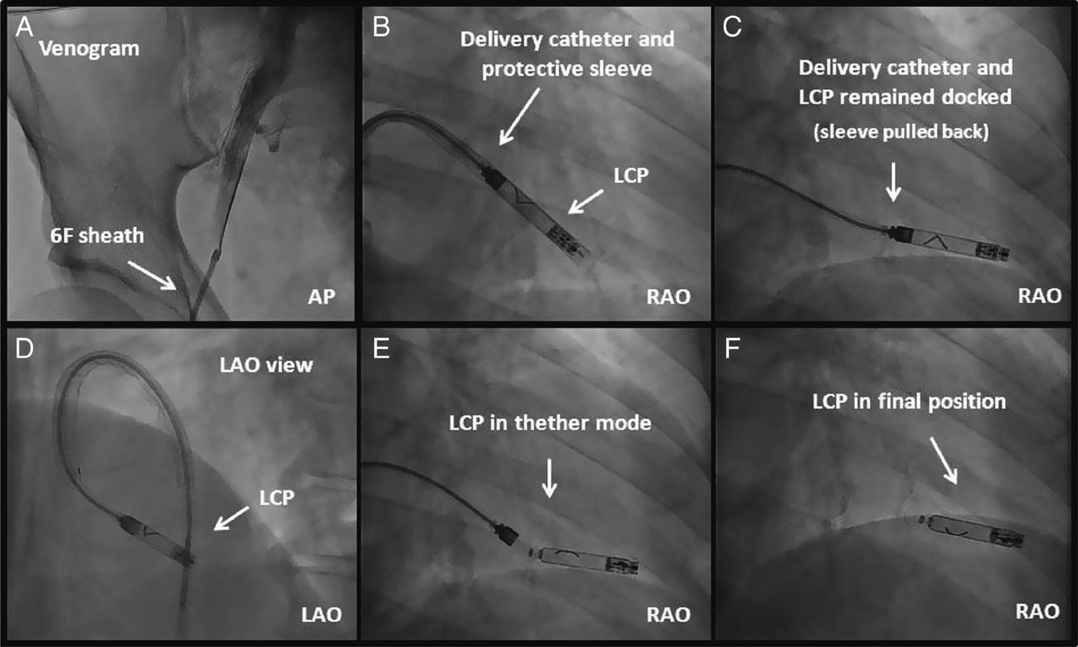 kardiovaskuler: Leadless Pacemaker: Langkah Maju Teknologi Kardiovaskular