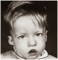 SALUD Y MEDICINA: El Síndrome DiGeorge