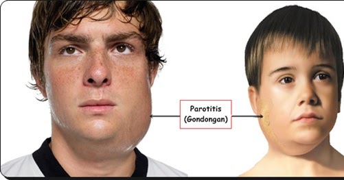 Obat Penyakit Parotitis (Gondongan) Herbal ~ Cara Mengobati Secara Alami