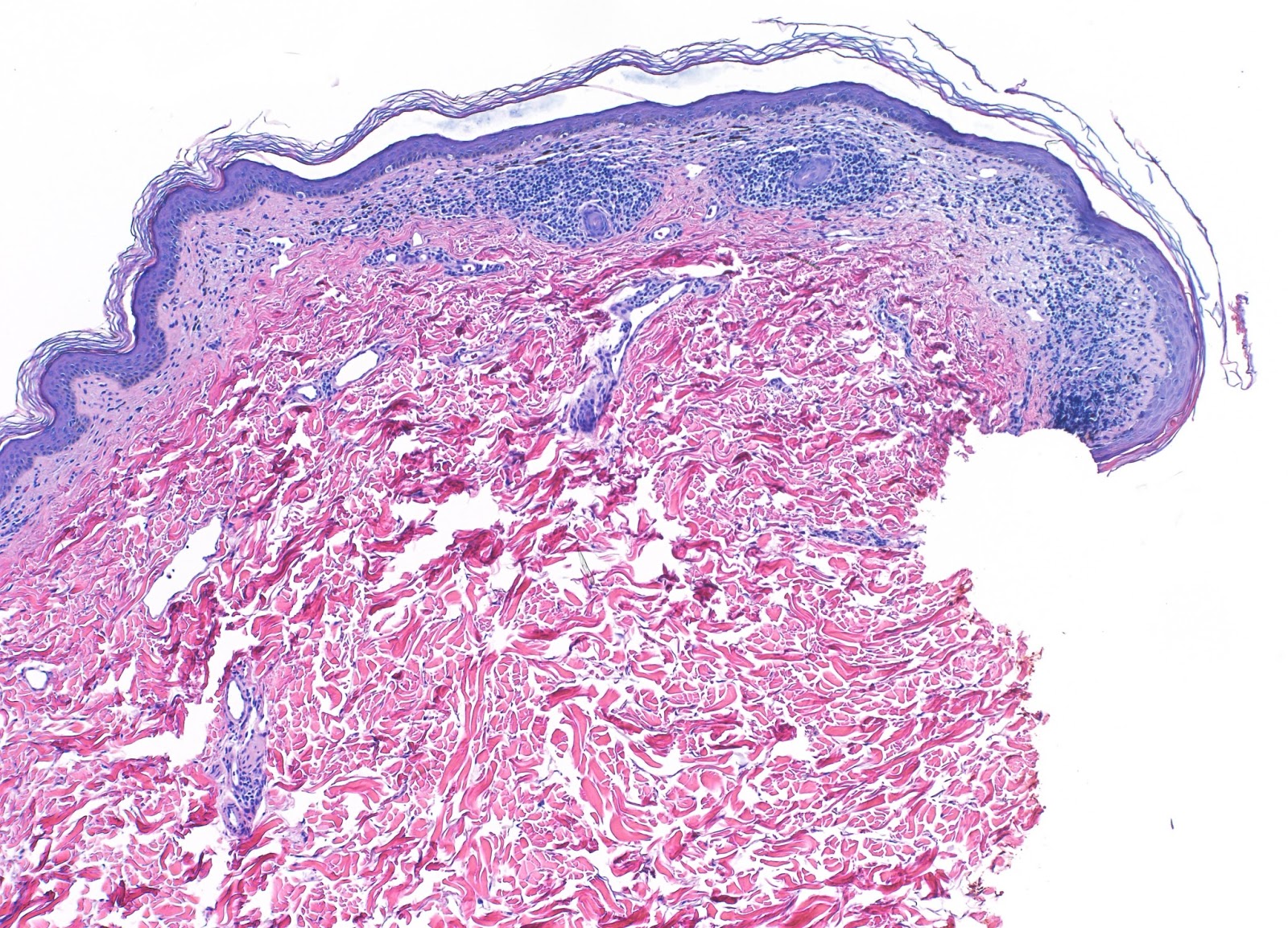 VIRTUAL GRAND ROUNDS IN DERMATOLOGY 2.0: May 2017
