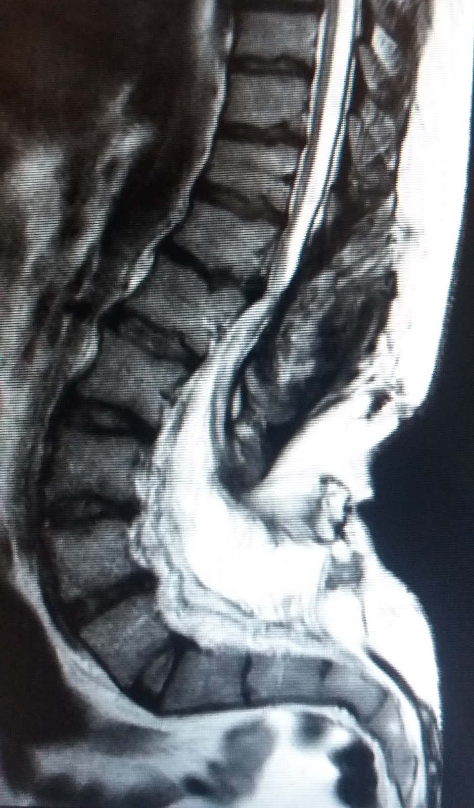 Síndrome Cauda Equina ~ Raio teste
