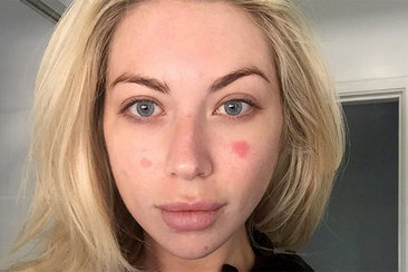 Stassi Schroeder Opens Up About Her Battle With Psoriasis With Makeup ...