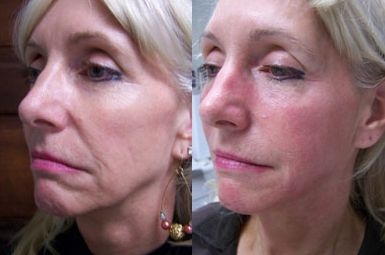 Facial Aerobics Exercises For Men And Women: Greatest Cheek Lifting And ...