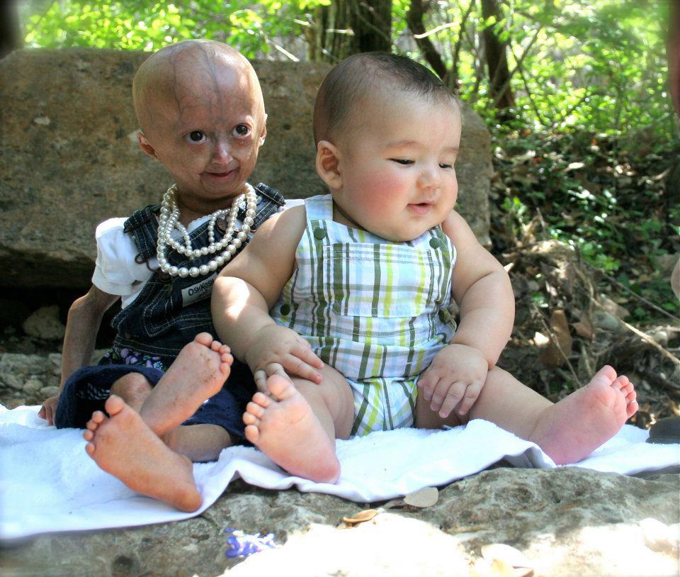 Blog da Júlia: Adalia Rose: uma menina especial