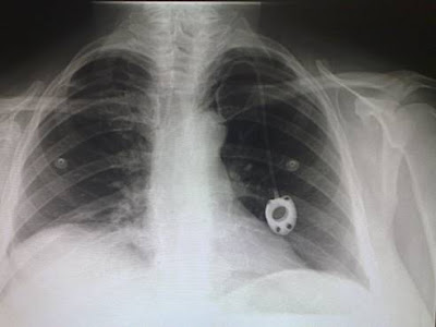 Dans la lutte contre le cancer: La mise en place du Port à Cathéter (PaC)