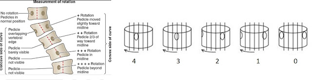 Scoliosis ( Skoliosis ): Penilaian Rotasi (Nash & Moe)