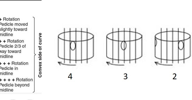 Scoliosis ( Skoliosis ): Penilaian Rotasi (Nash & Moe)
