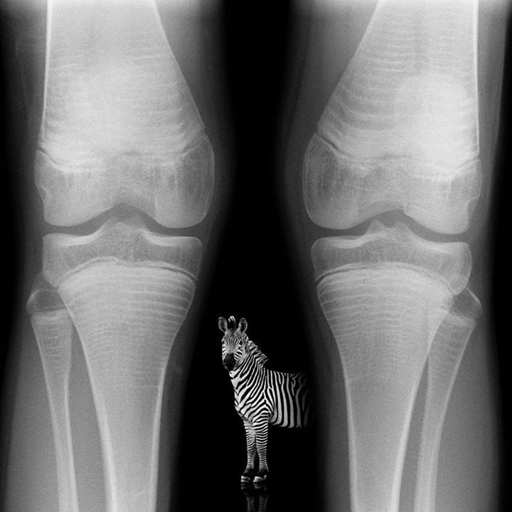 Tecnicos Radiologos: ¿Qué son las 'líneas de cebra' en la Radiografía ósea?