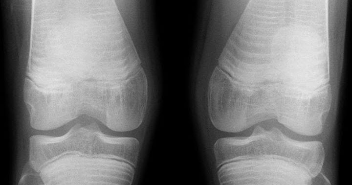 Tecnicos Radiologos: ¿Qué son las 'líneas de cebra' en la Radiografía ósea?