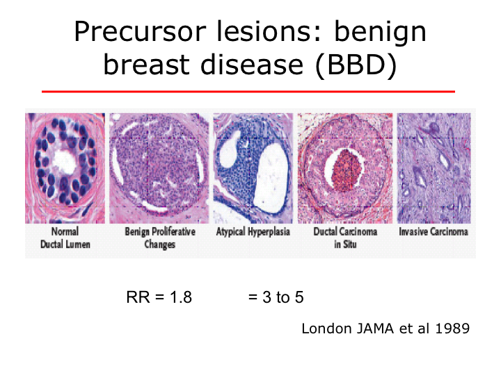 Further evidence that alcohol causes breast cancer | Public Health ...