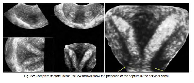 Nagendra's Radiology Blog: SEPTATE AND ARCUATE UTERUS ----PICTORIAL ...