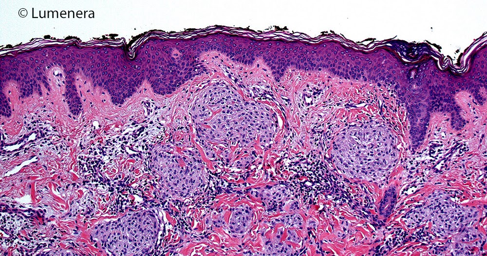 Microscope World Blog: Cellular Neurothekeoma under the Microscope