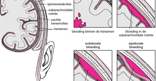 Medische Kennis: Traumatologie: schedel/hersenletsel