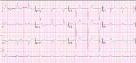 Dr. Smith's ECG Blog: CHF Exacerbation with Old LBBB: Is There New ...