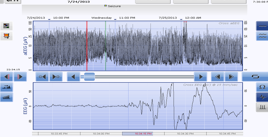 소아청소년과 전공의를 위한 교육자료: 진폭통합뇌파 (amplitude integrated EEG, aEEG)란 무엇인가?
