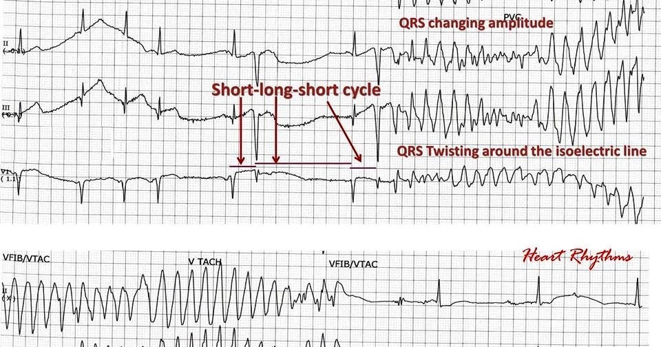 ECG Rhythms: ECG characteristics of Torsades de Pointes (TdP)