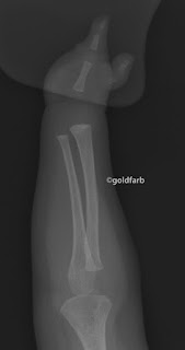 Hand Limitations in Ulnar Longitudinal Deficiency | Congenital Hand and ...