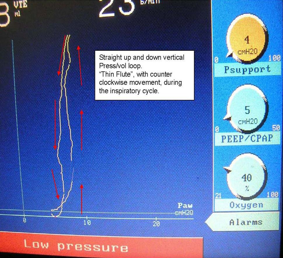 FREMITUS: Performing a T-Piece Trial with the Ventilator