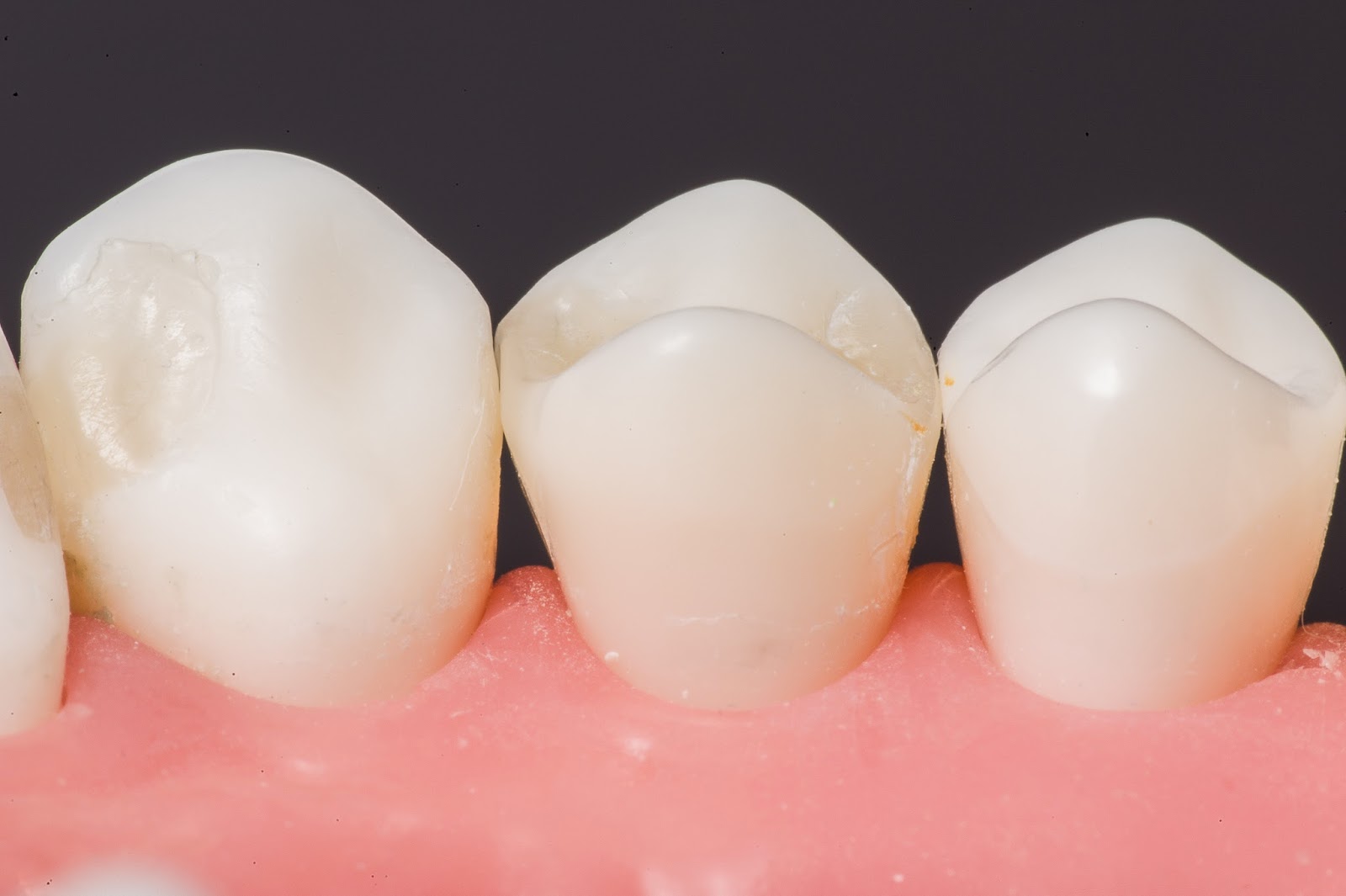 MOD Composite Preparation and Restoration 1: #14 MO Preparation #12 MOD ...