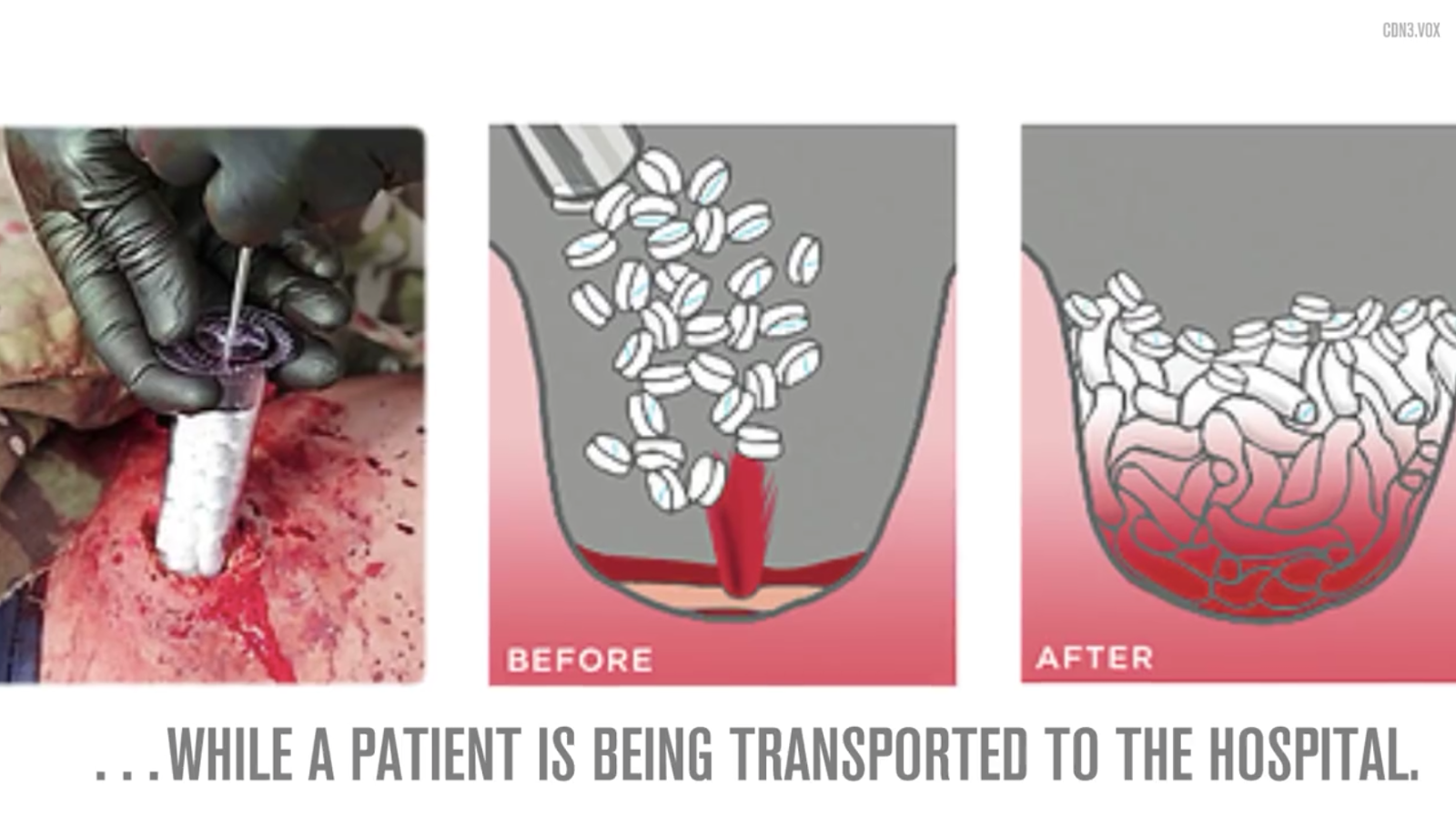 EMS SOLUTIONS INTERNATIONAL: Xstat Instructional "SEALS A GUNSHOT WOUND ...