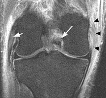 Radiology Channel: Anatomy of bundles of ACL and PCL.