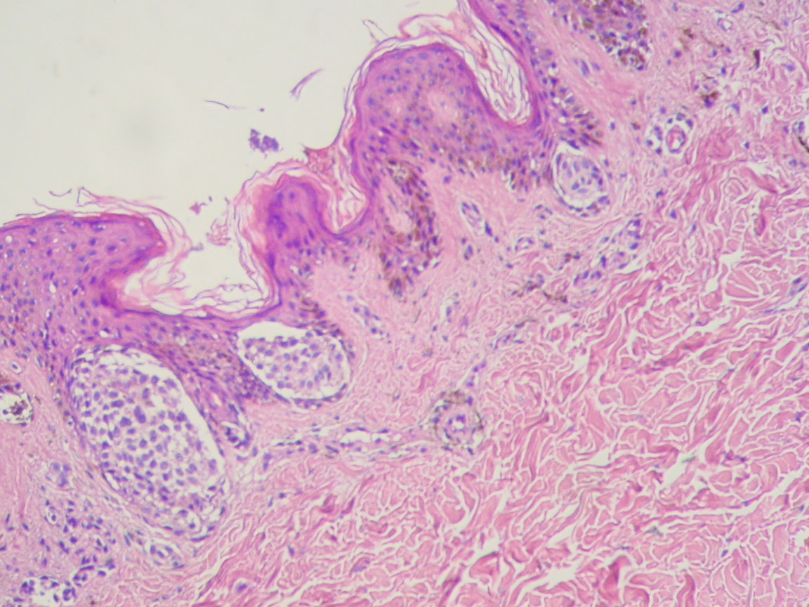 Nevo Melanocítico Composto Displásico - RETOEDU