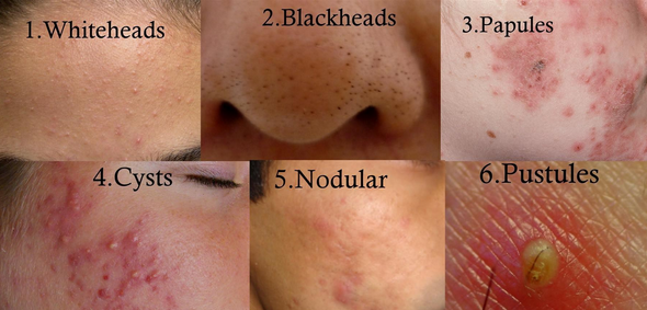 Acne Definition Causes Complications And Treatment The Thesis acne-definition-causes-complications-and-treatment-the-thesis