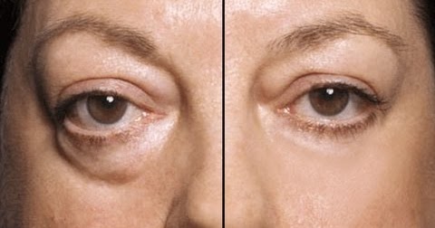 How to Get Rid of Puffy Eyes Without Surgery: WHAT ARE THE CAUSES OF ...