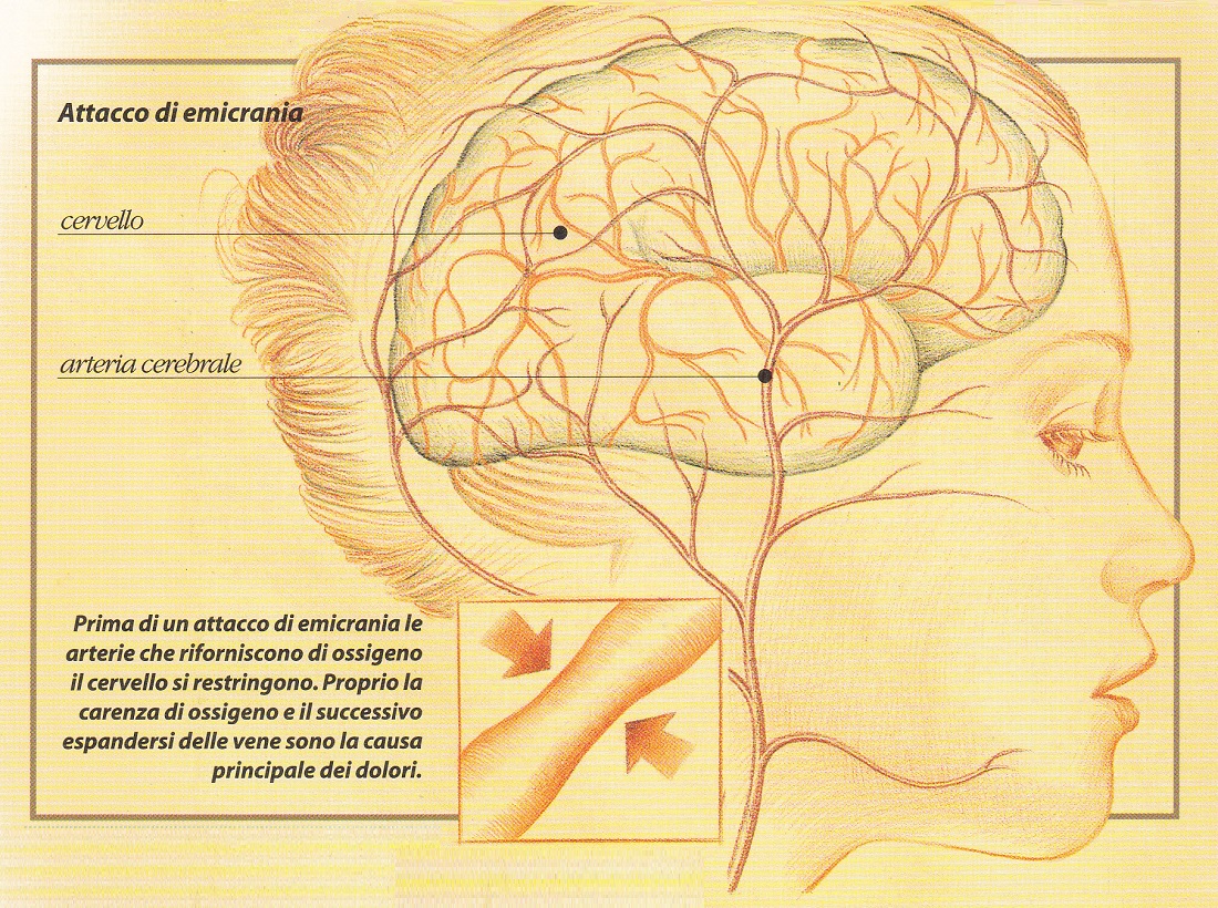 RIMEDI contro EMICRANIA - Blog di pociopocio