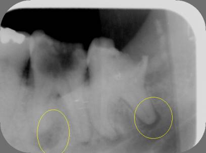 RADIOLOGIA DE LA CARIES DENTAL