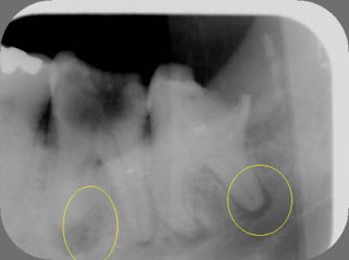 RADIOLOGIA DE LA CARIES DENTAL