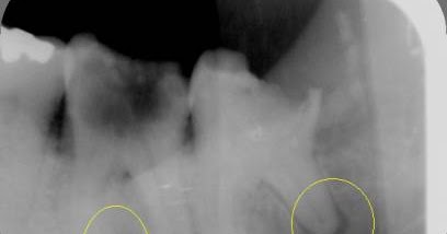 RADIOLOGIA DE LA CARIES DENTAL