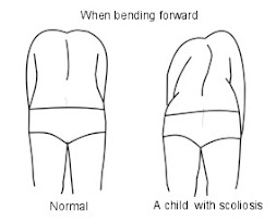 Scoliosis - Skoliosis: Lordosis and Kyphosis