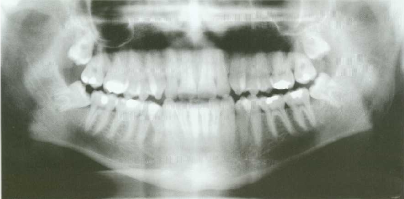 hiphoplife: Removal of Partially-erupted mesio-angular lower third molar