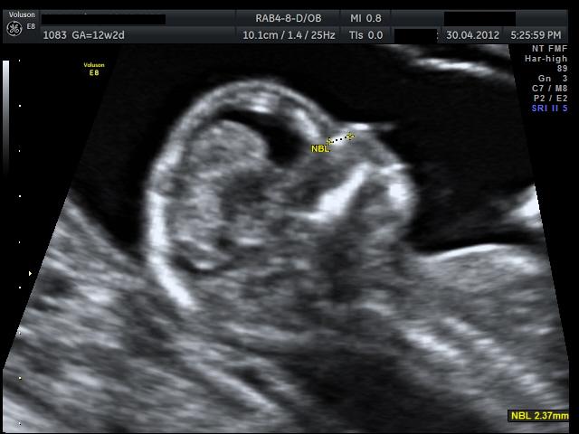 IVF Hope: 12 week NT Scan!! (updated pics)