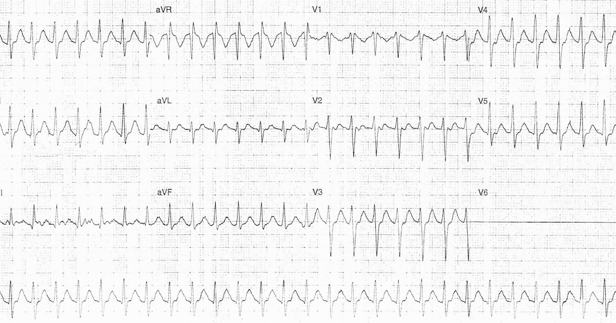 ECG of the Week: ECG of the Week - 7th May 2018 - Interpretation